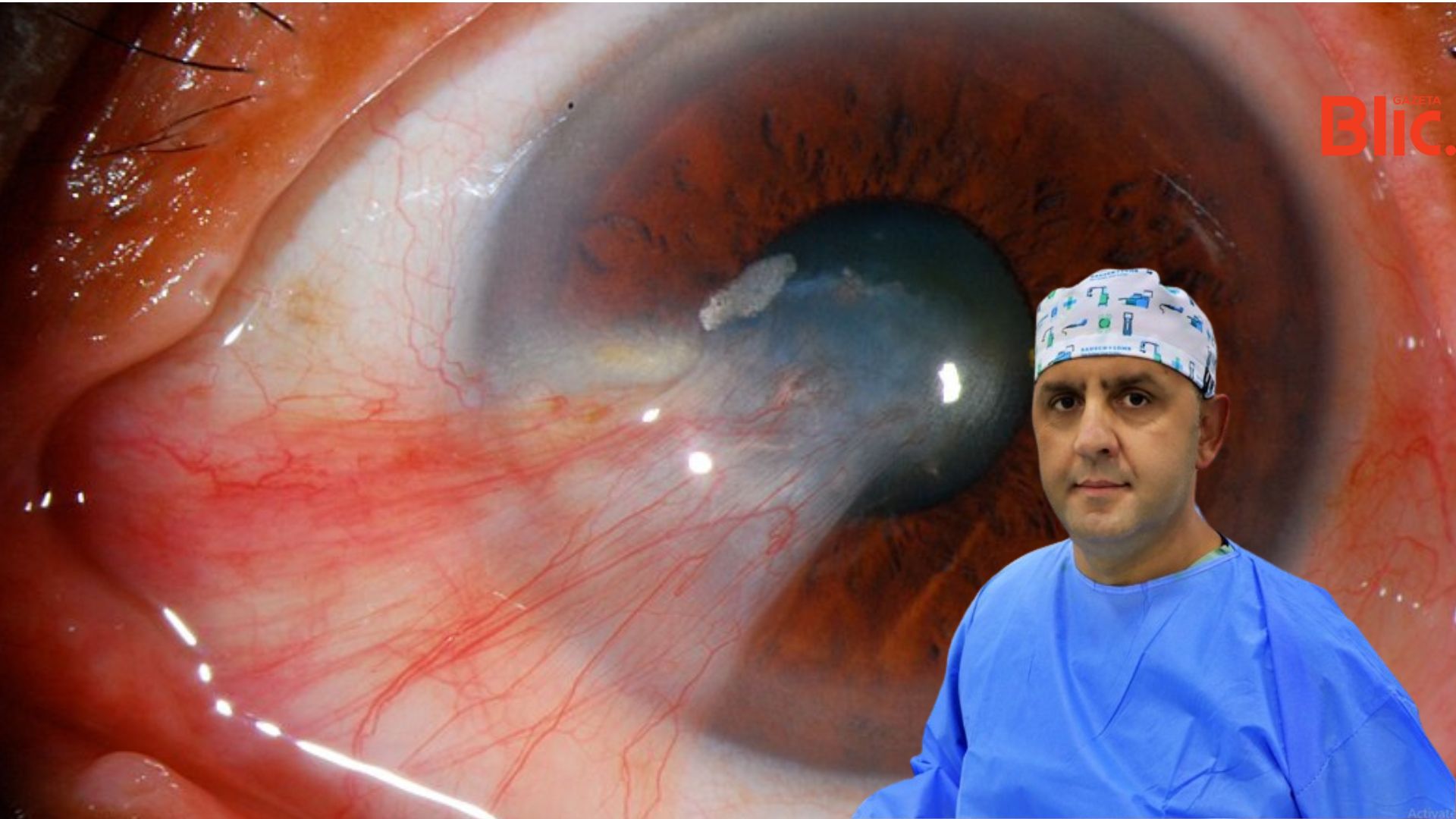 Sëmundja e cipës së syrit, simptomat dhe mënyra e trajtimit/ Flet ...